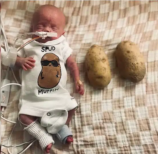 Bebê mais prematuro do mundo com 283 gramas celebra 1 ano