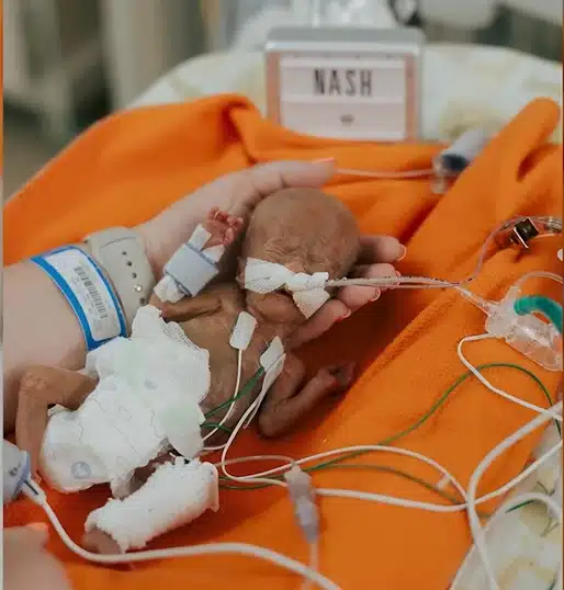 Bebê mais prematuro do mundo com 283 gramas celebra 1 ano